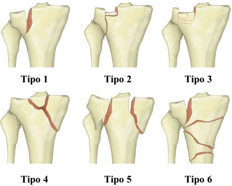 Fratura do Platô Tibial, você sabe o que é? – Orthomed Center ...